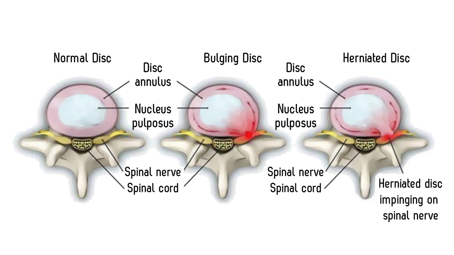 Your Disc Injury Didn't 'Just Happen - Osteopathy in Springwood ...