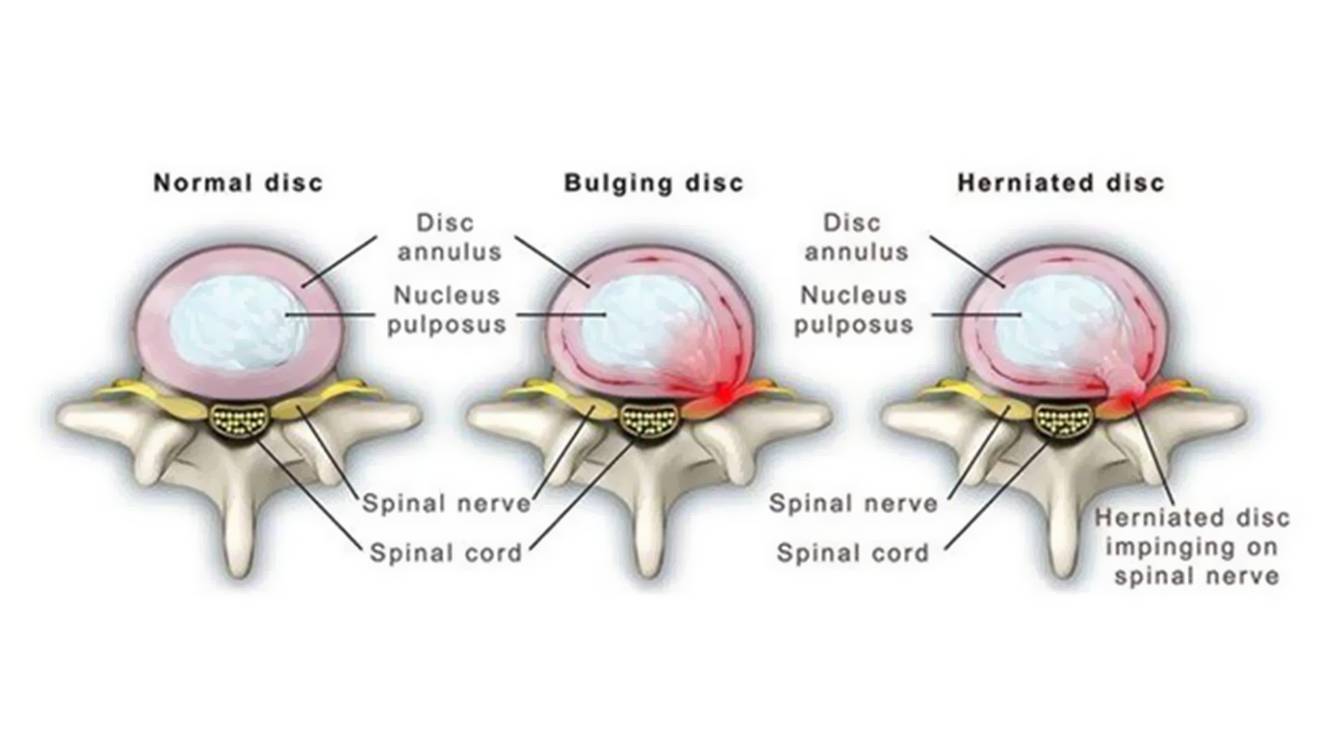 H2TH Diagram of Disc 2024 - Osteopathy in Springwood, Brisbane and ...